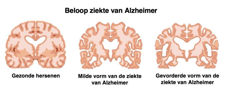 Ziekte van Alzheimer | Dementie
